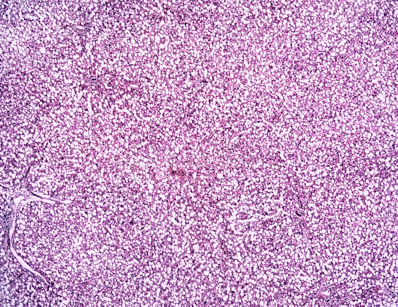 Liver Fatty Hepatosis of a Human Stock Image - Image of epidermoid ...