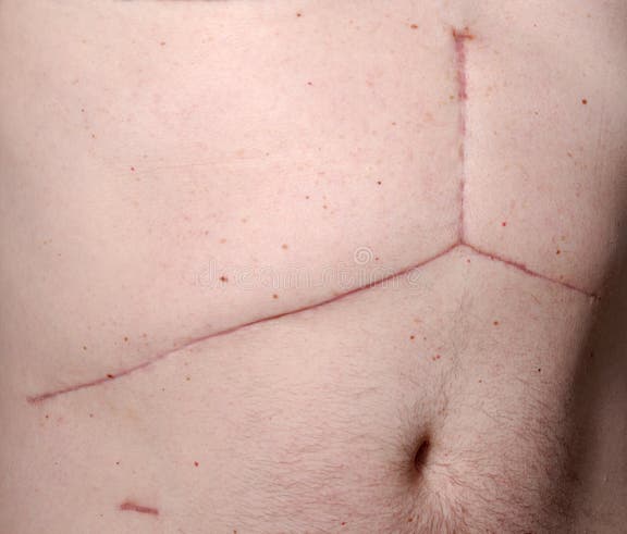 Liver transplant scar stock photo. Image of medical, replant - 7695238