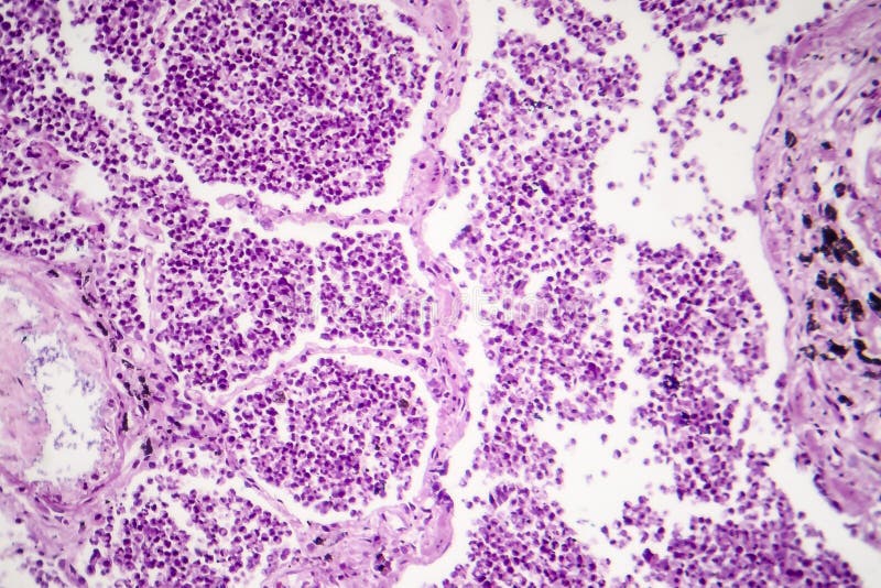 Lobar Pneumonia, Grey Hepatic Phase Stock Image - Image of microscopic ...