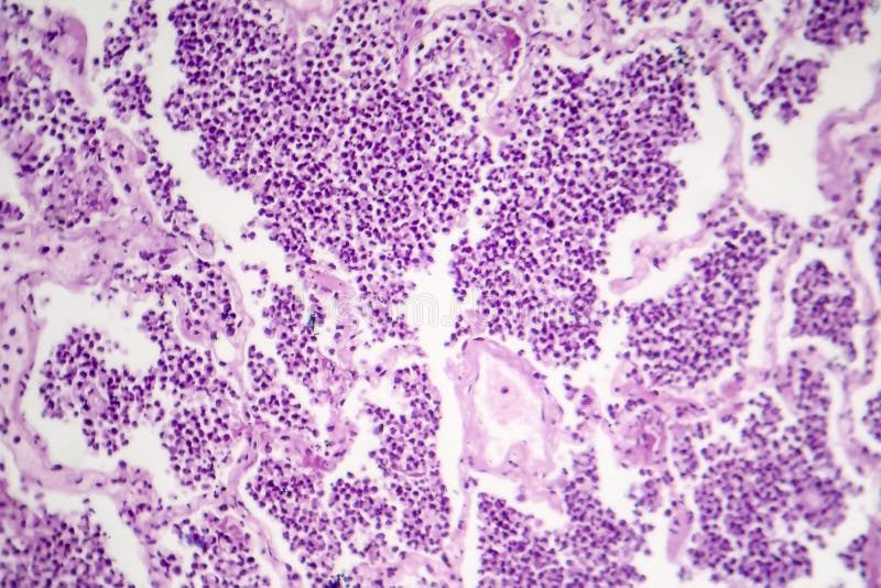 Lobar Pneumonia, Grey Hepatic Phase Stock Image - Image of hematoxylin ...