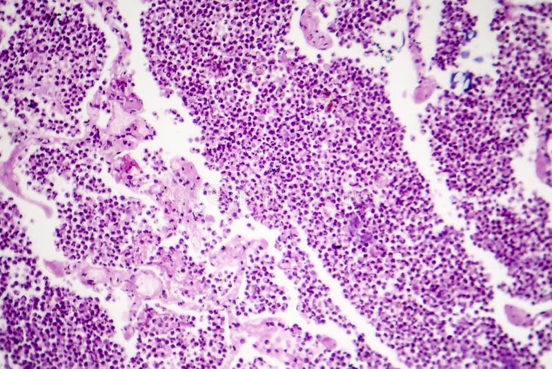 Lobar Pneumonia, Grey Hepatic Phase Stock Photo - Image of lung ...