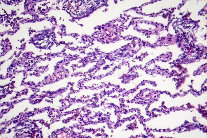 Lobar Pneumonia, Resolution Period Stock Photo - Image of lung ...