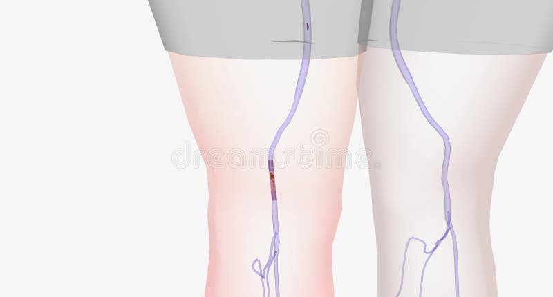 Location of Deep Vein Thrombosis Stock Illustration - Illustration of ...