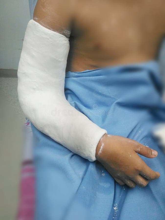 Boy with Broken Arm, Plaster on Arm As Therapy. Close Up of a Young Man ...