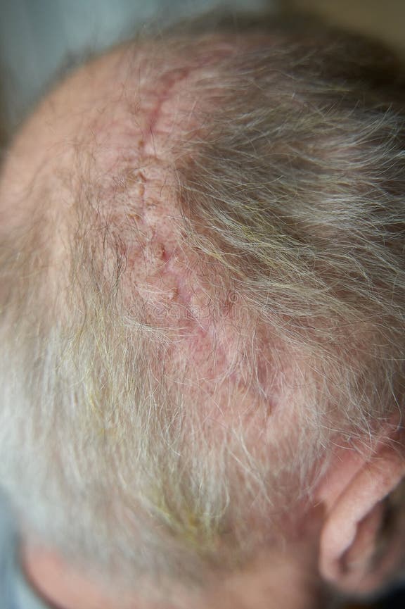 A Long Cicatrix Over the Head after an Operation Stock Image - Image of ...
