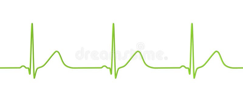 Long QT Syndrome ECG, 1st Type, 3D Illustration Stock Illustration ...