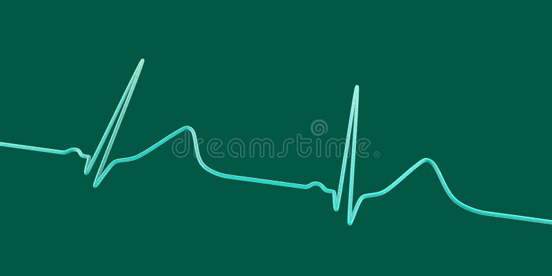 Long QT Syndrome ECG, 1st Type, 3D Illustration Stock Illustration ...