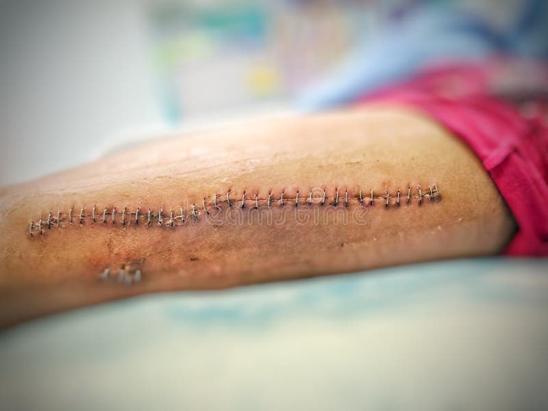 Long scar on leg stock image. Image of long, scar, staples - 101559785