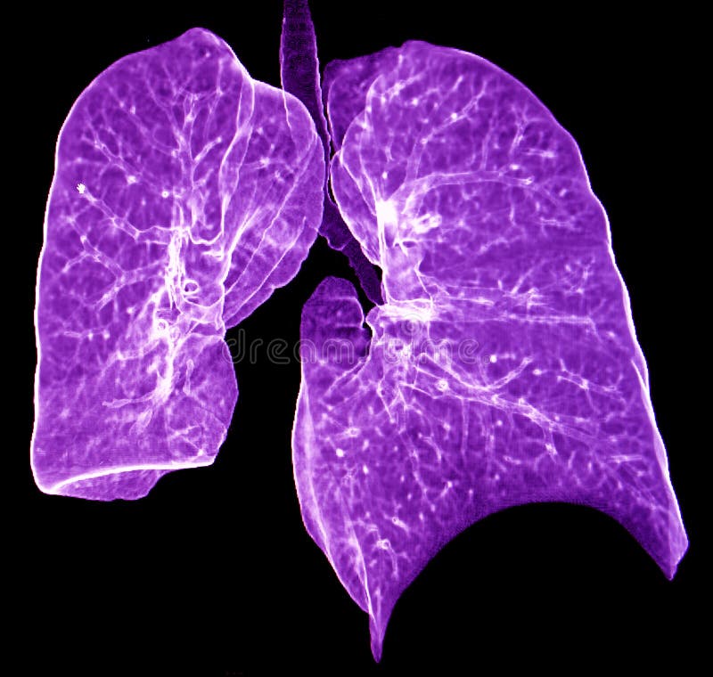 De longen van rokers stock foto. Image of gevolgen, roker - 945380