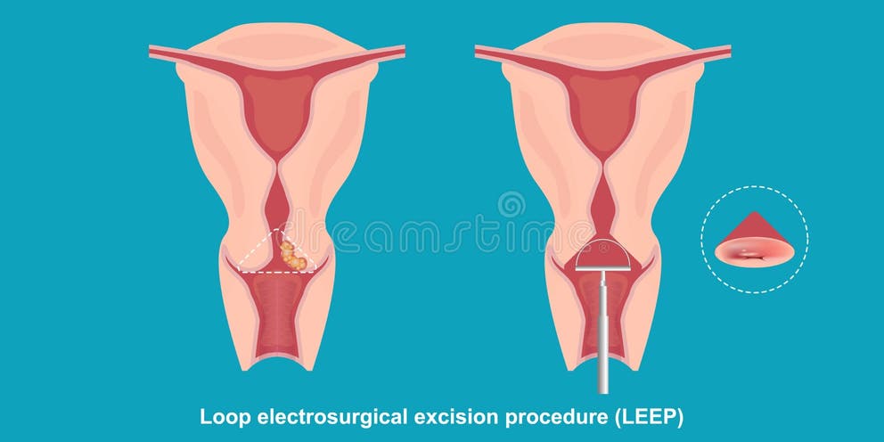 Excision Procedure Stock Illustrations 50 Excision Procedure Stock Illustrations Vectors