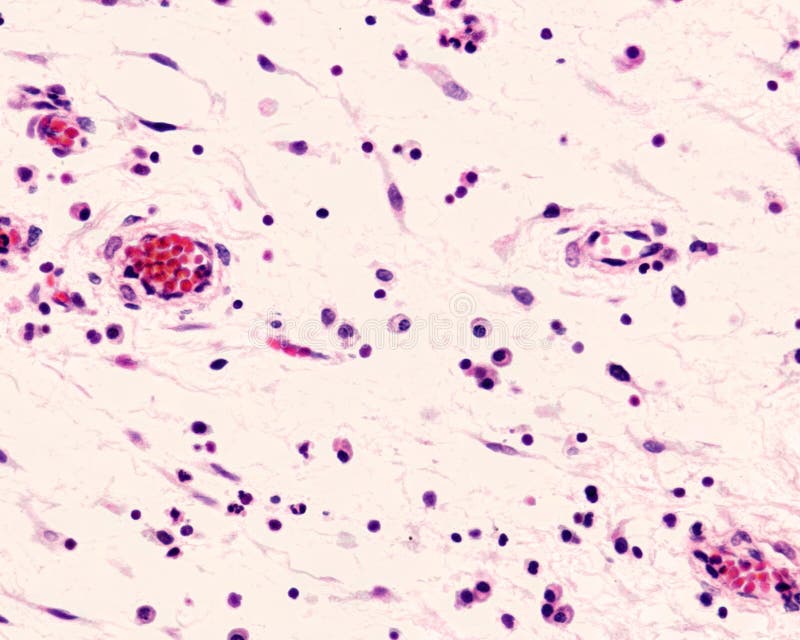 Loose Connective Tissue. Chronic Inflammation Stock Image - Image of ...