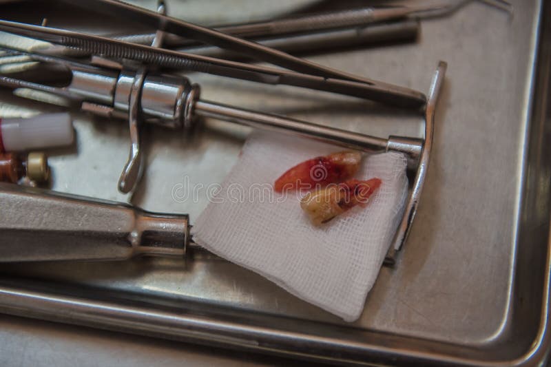 Loss of Teeth from Tooth Extraction by the Dentist. Dentistry in ...