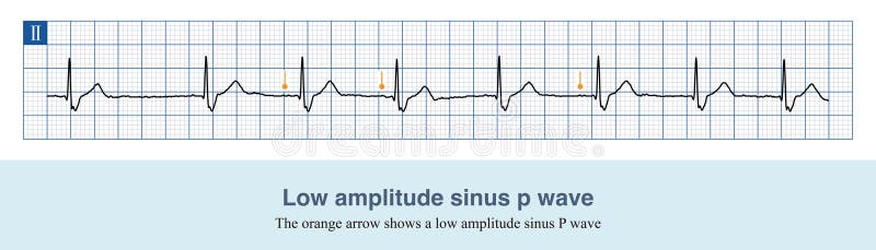 Low amplitude sinus p wave stock image. Image of potential - 364755461