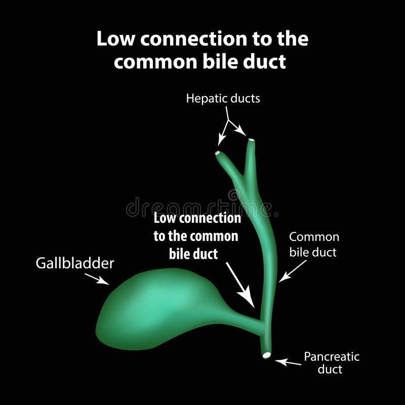 Bile Duct Welded To the Common Bile Duct. Pathology of the Gallbladder ...