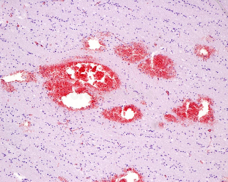 Cerebral microhemorrhages stock photo. Image of body - 303145920