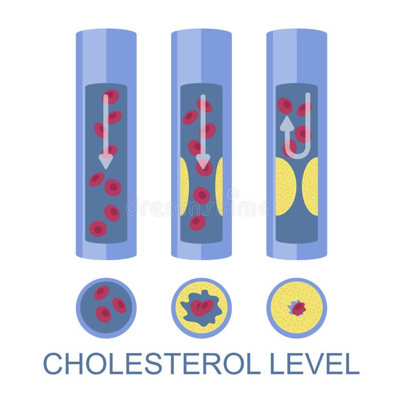 Low, Normal, High Cholesterol Level, Vector Illustration. High Ldl Risk ...