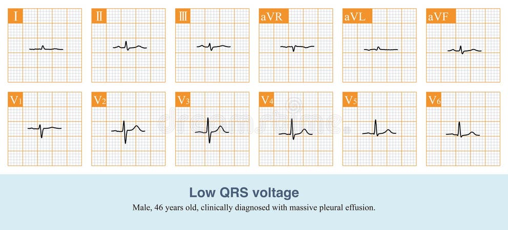 Low QRS voltage stock photo. Image of positive, pericardial - 380814966