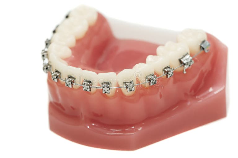 Lower Dental Jaw Bracket Braces Stock Image - Image of orthodontist ...