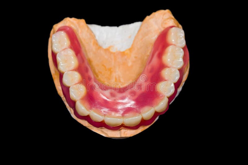 Lower Denture with Two Implants Stock Photo - Image of hygiene, acrylic ...