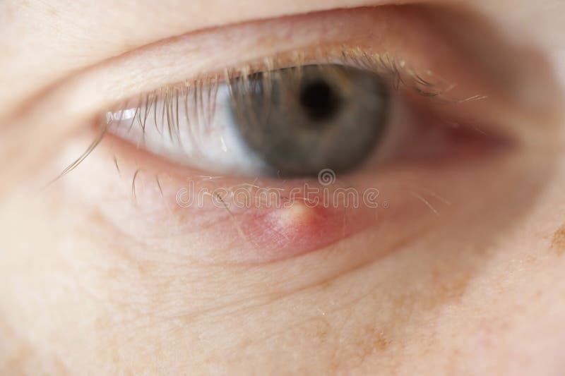Red Lower Eyelid, a Macro Photo of the Human Eye. Conjunctivitis ...