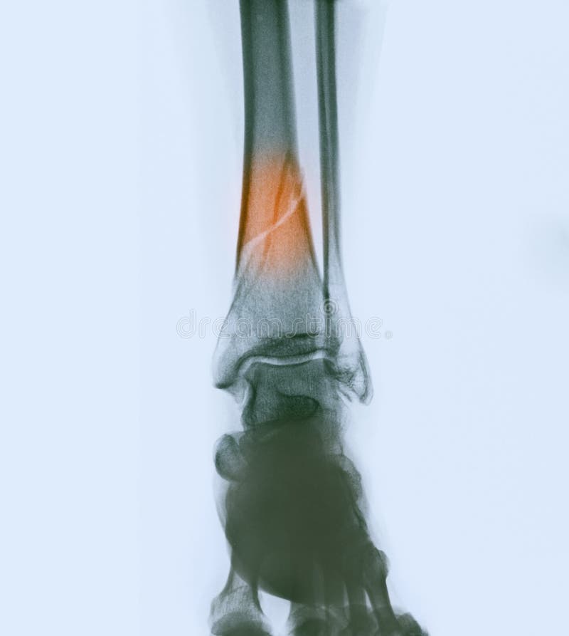 Lower leg fracture stock photo. Image of injury, trauma - 19294748