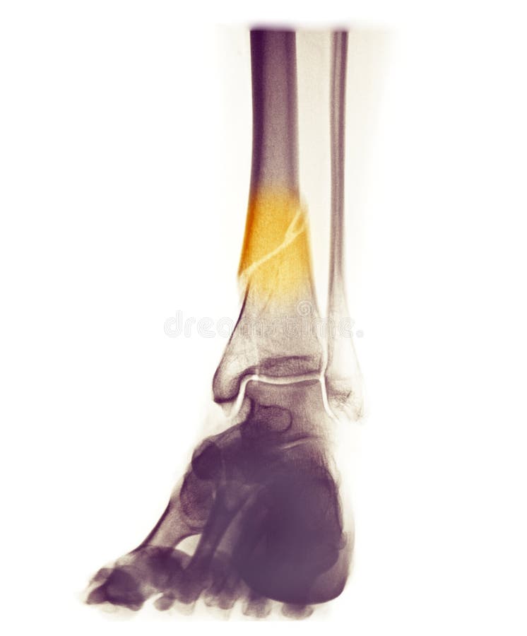 Lower leg fracture stock photo. Image of injury, trauma - 19294748