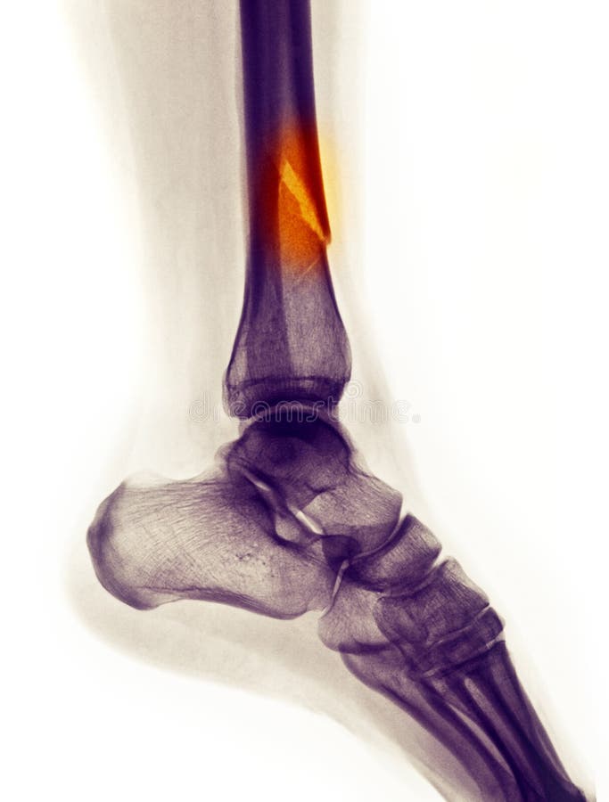 Lower leg fracture stock photo. Image of injury, trauma - 19294748