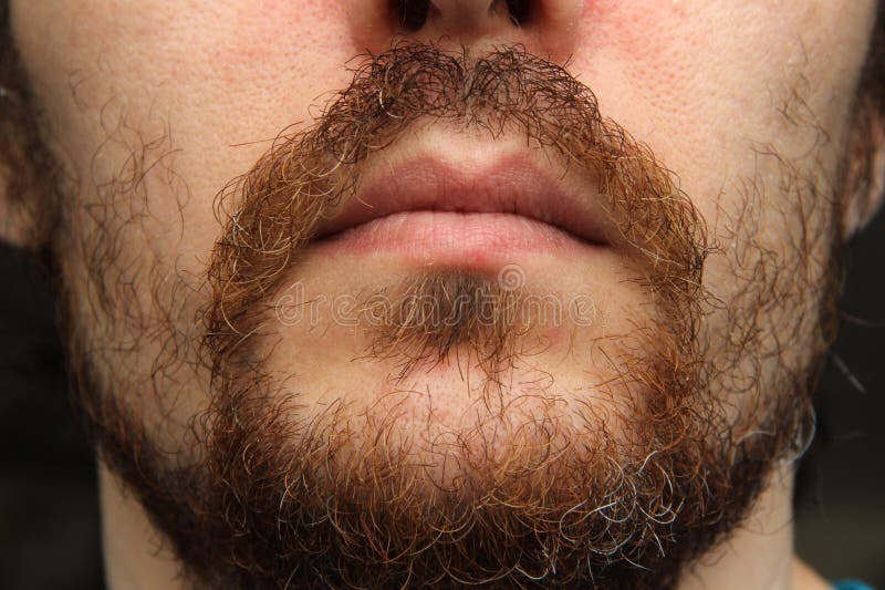 Part of the Face with the Nose of an Adult White Man with Dry, Flaky ...