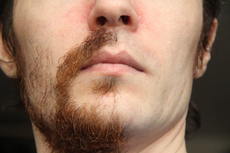 Part of the Face with the Nose of an Adult White Man with Dry, Flaky ...