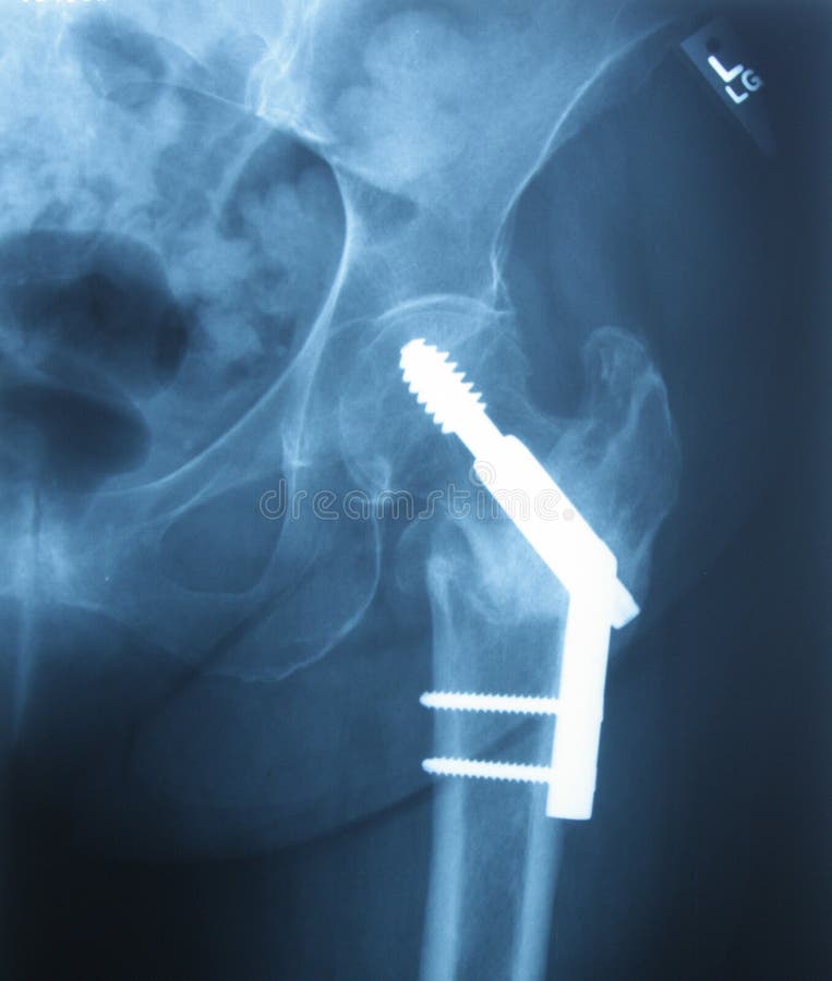 Lt Hip Prosthesis stock photo. Image of joint, bone, marker - 19277288