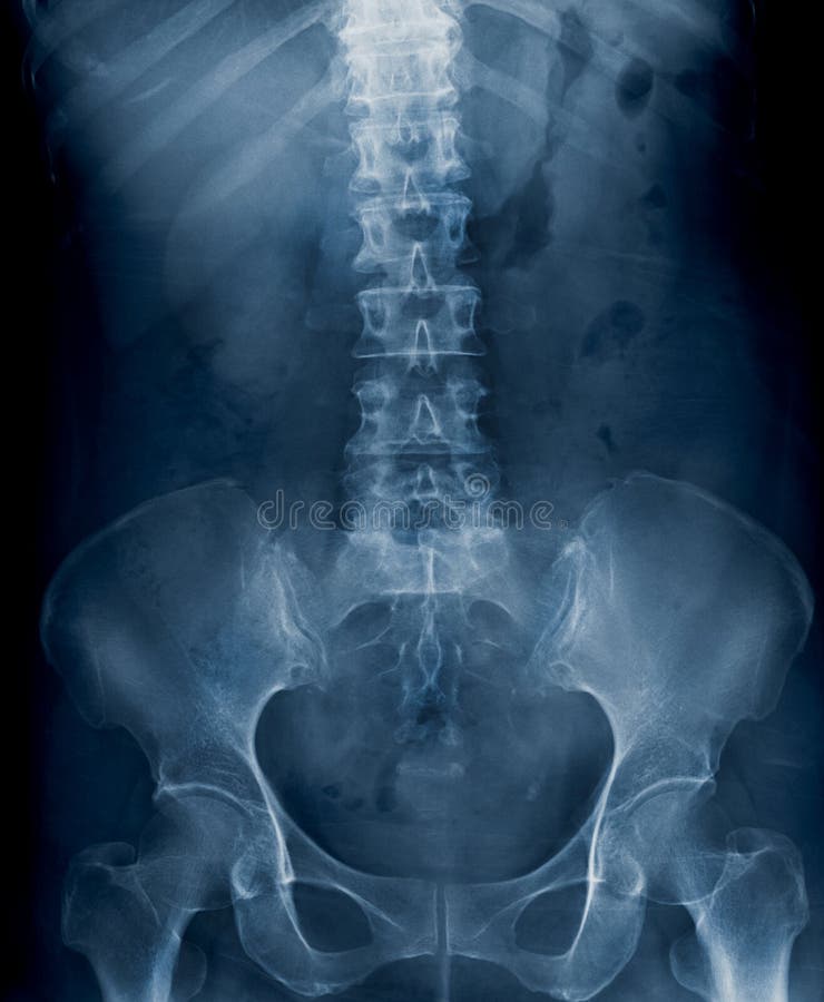 Lumbaal Spondylosis X-ray Beeld Stock Foto - Image of lichaam, anatomie ...