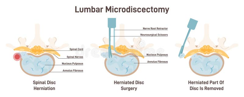 Microdiscectomy Stock Illustrations – 2 Microdiscectomy Stock ...
