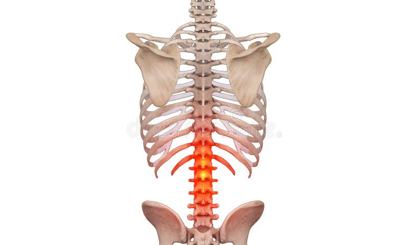 Lumbar Section of the Spine Back View with Injury Stock Illustration ...