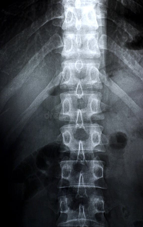 Lumbar spine/front view stock photo. Image of hospital - 198780