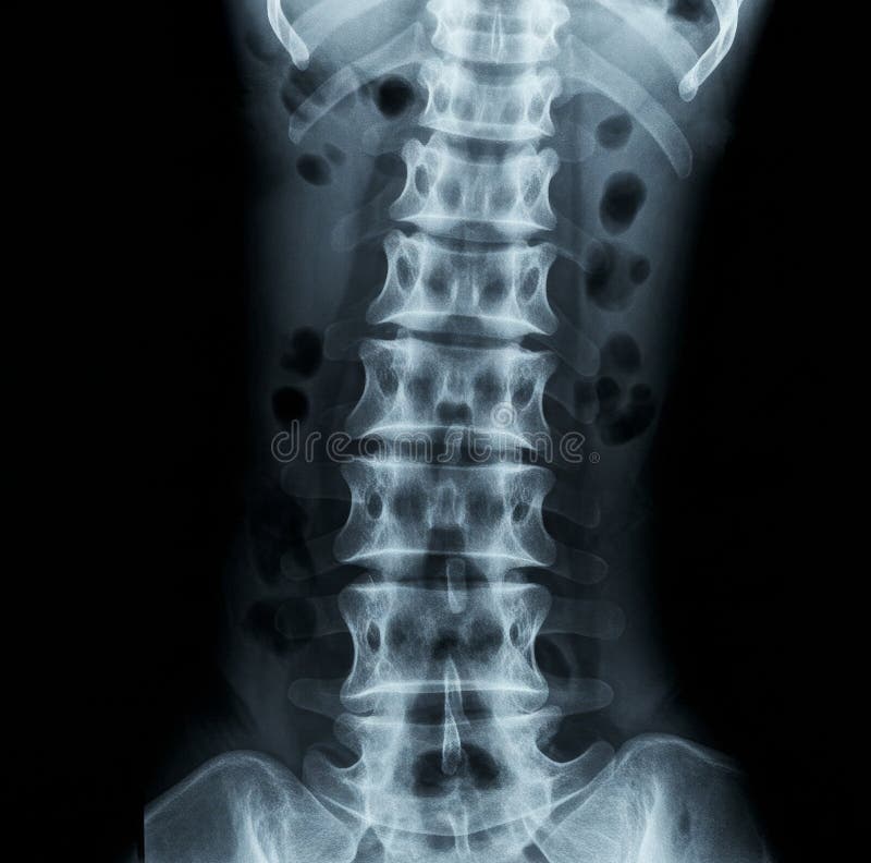Lumbar Spine XRay a Detailed Xray Showcasing the Lumbar Spine Revealing ...