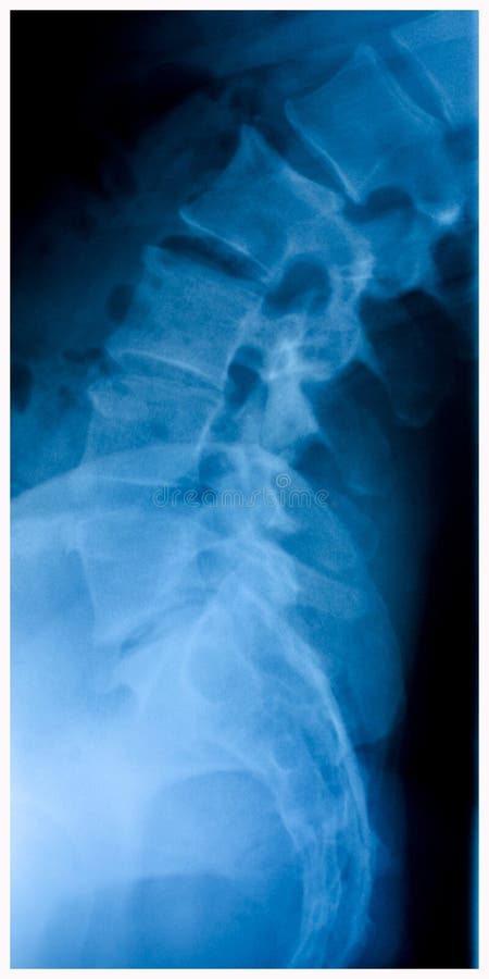 Lumbar spine x-ray stock image. Image of humeral, fracture - 41649285