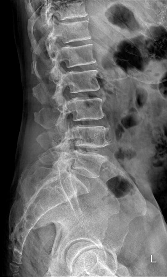 Lumber Spine Lateral Radiograph Stock Image - Image of lateral, spine ...