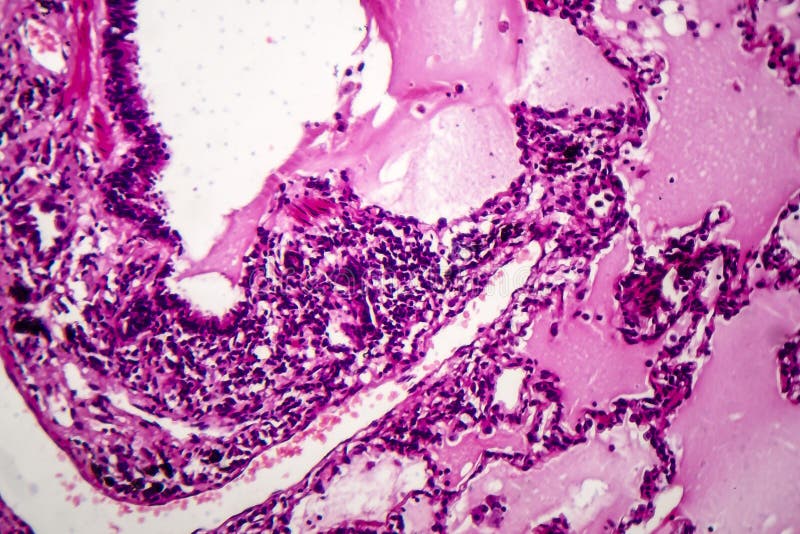 Lung Adenocarcinoma, Light Micrograph Stock Photo - Image of medicine ...