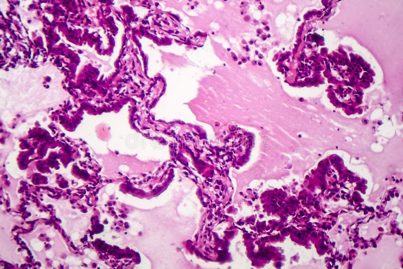 Lung Adenocarcinoma, Light Micrograph Stock Photo - Image of medicine ...