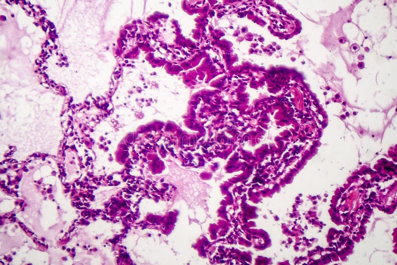 Lung adenocarcinoma stock photo. Image of pathology - 130900758