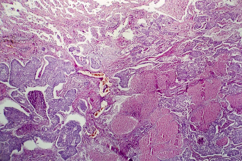 Lung adenocarcinoma stock image. Image of tumour, microscopy - 130900741