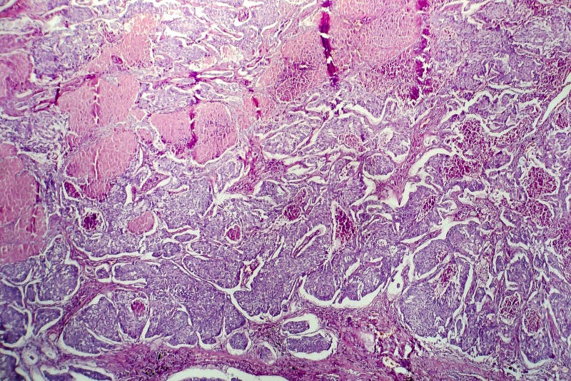 Lung Adenocarcinoma, Light Micrograph Stock Image - Image of pulmonary ...