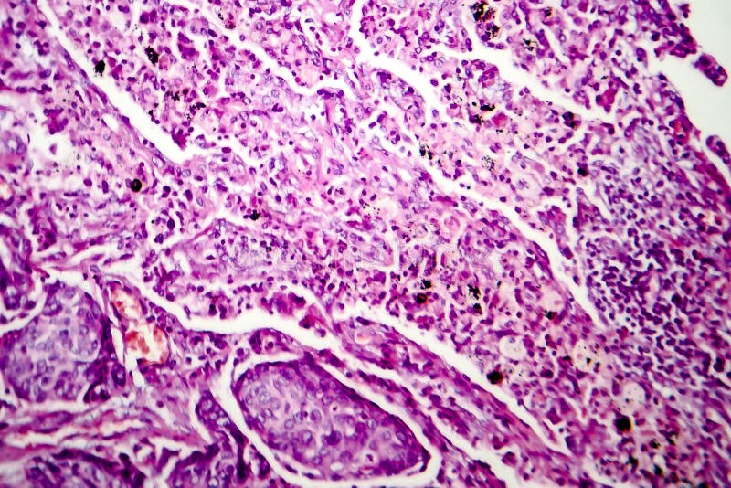 Lung Adenocarcinoma, Light Micrograph Stock Photo - Image of medicine ...