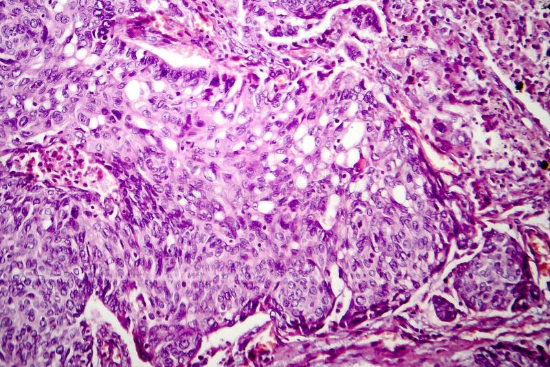 Lung Adenocarcinoma, Light Micrograph Stock Image - Image of tumour ...