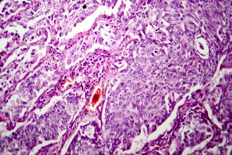 Lung Adenocarcinoma, Light Micrograph Stock Illustration - Illustration ...