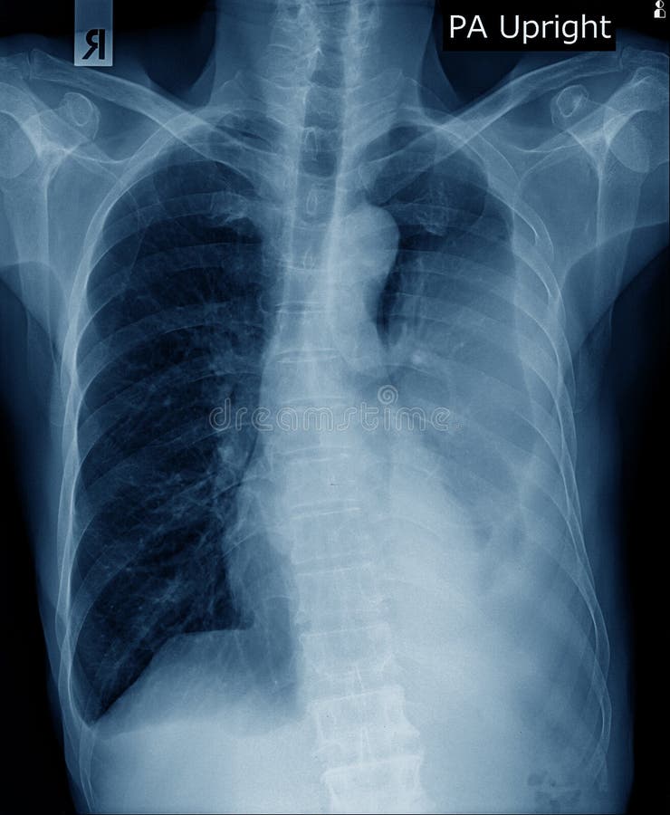 Lung atelectasis stock illustration. Illustration of checkup - 110457743