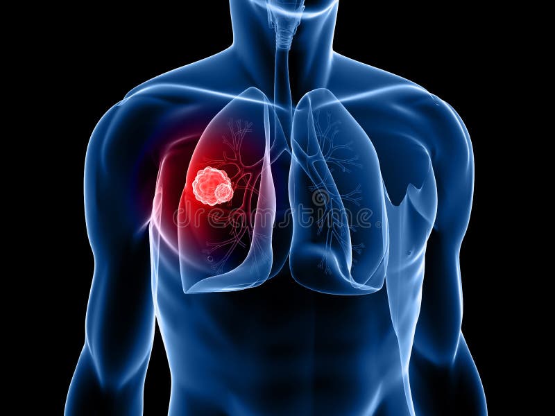 Lung cancer stock illustration. Illustration of chest - 11953356