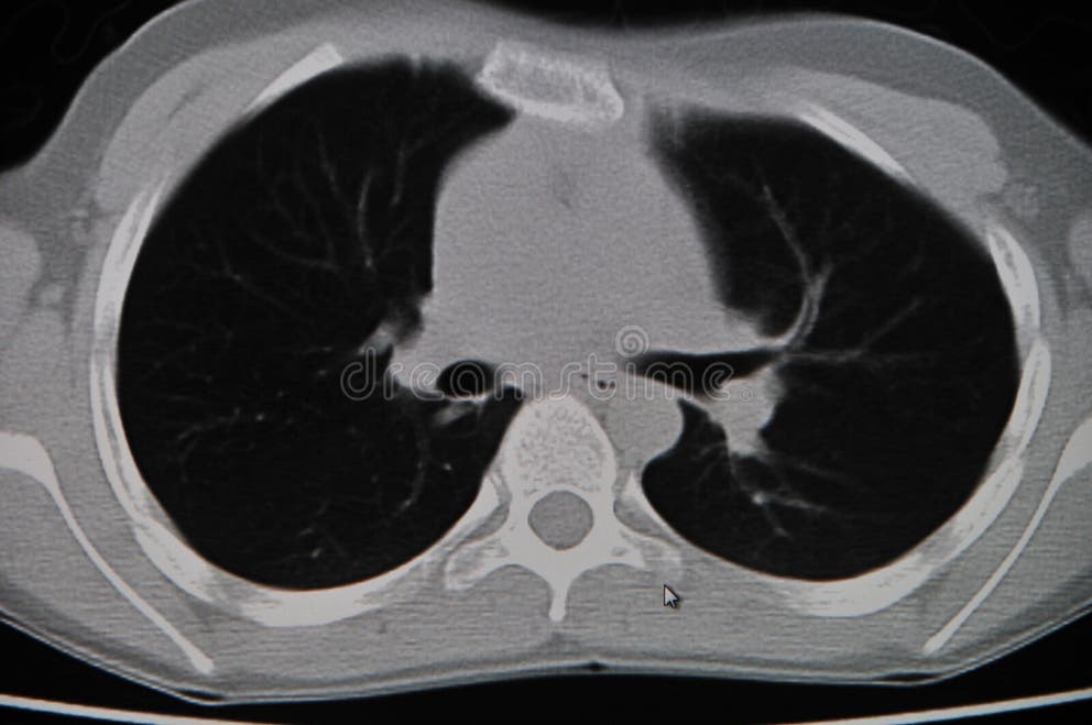 Lung CT stock image. Image of tomography, scan, imaging - 83533179