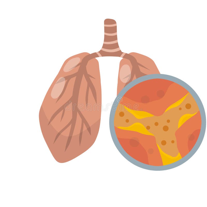 Lung Disease. Vector Blockage of Canal Stock Vector - Illustration of ...
