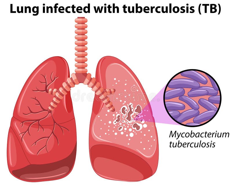 Lung Infected with Tuberculosis Stock Vector - Illustration of virus ...